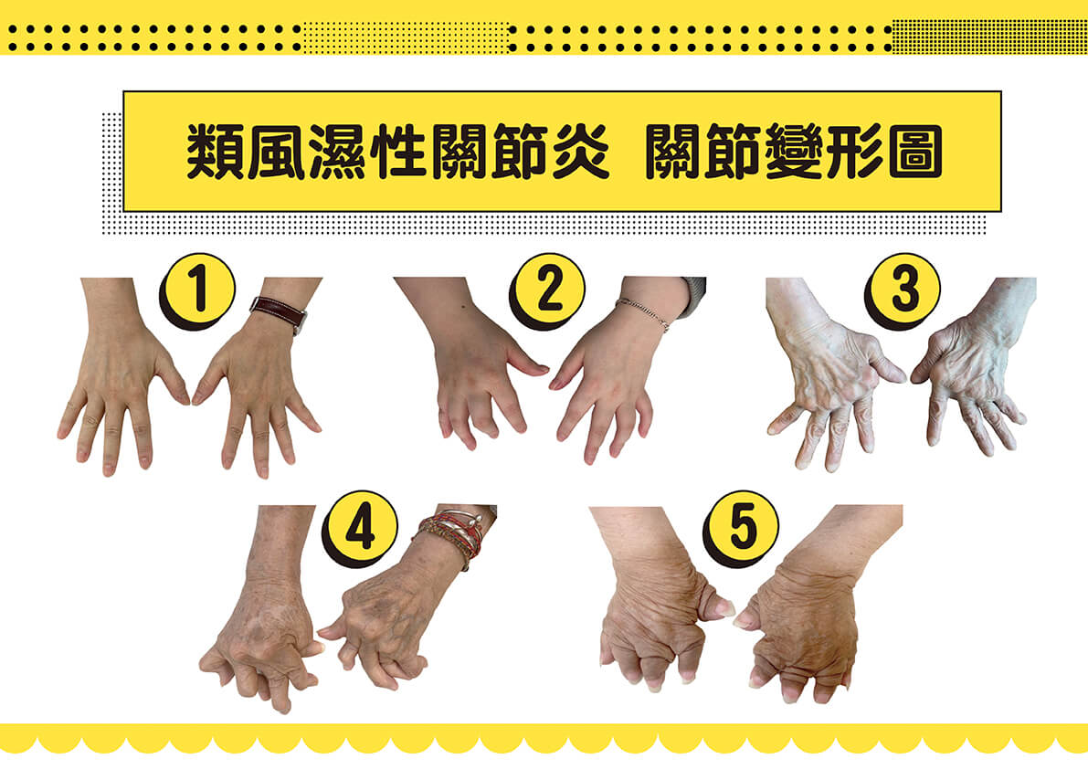 怕染疫不回診！類風濕性關節炎病友3個月後竟關節變形 今健康